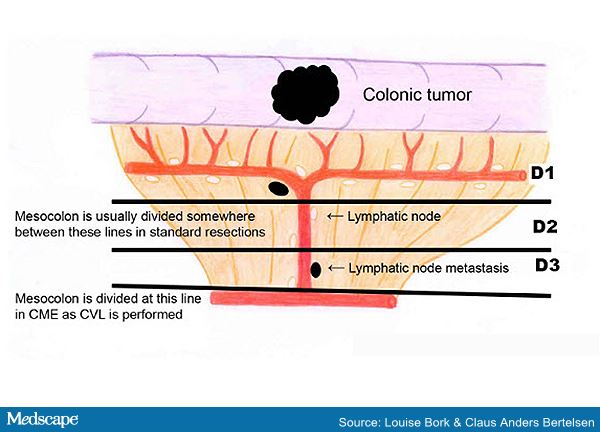 CME - complete mesocolic excision geeft veel betere resultaten - 10 tot ...