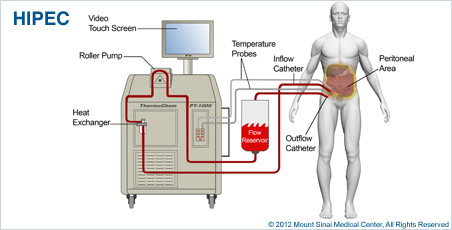 Hoe kunnen oncologen het beste patienten selecteren voor een operatie ...