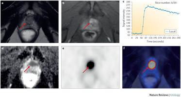 PSMA - Prostate Specific Membrane Antigen samen met pet / CT scan ...