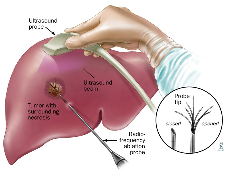VUmc start COLLISION-studie: radiofrequente ablatie (RFA) en microwave ...
